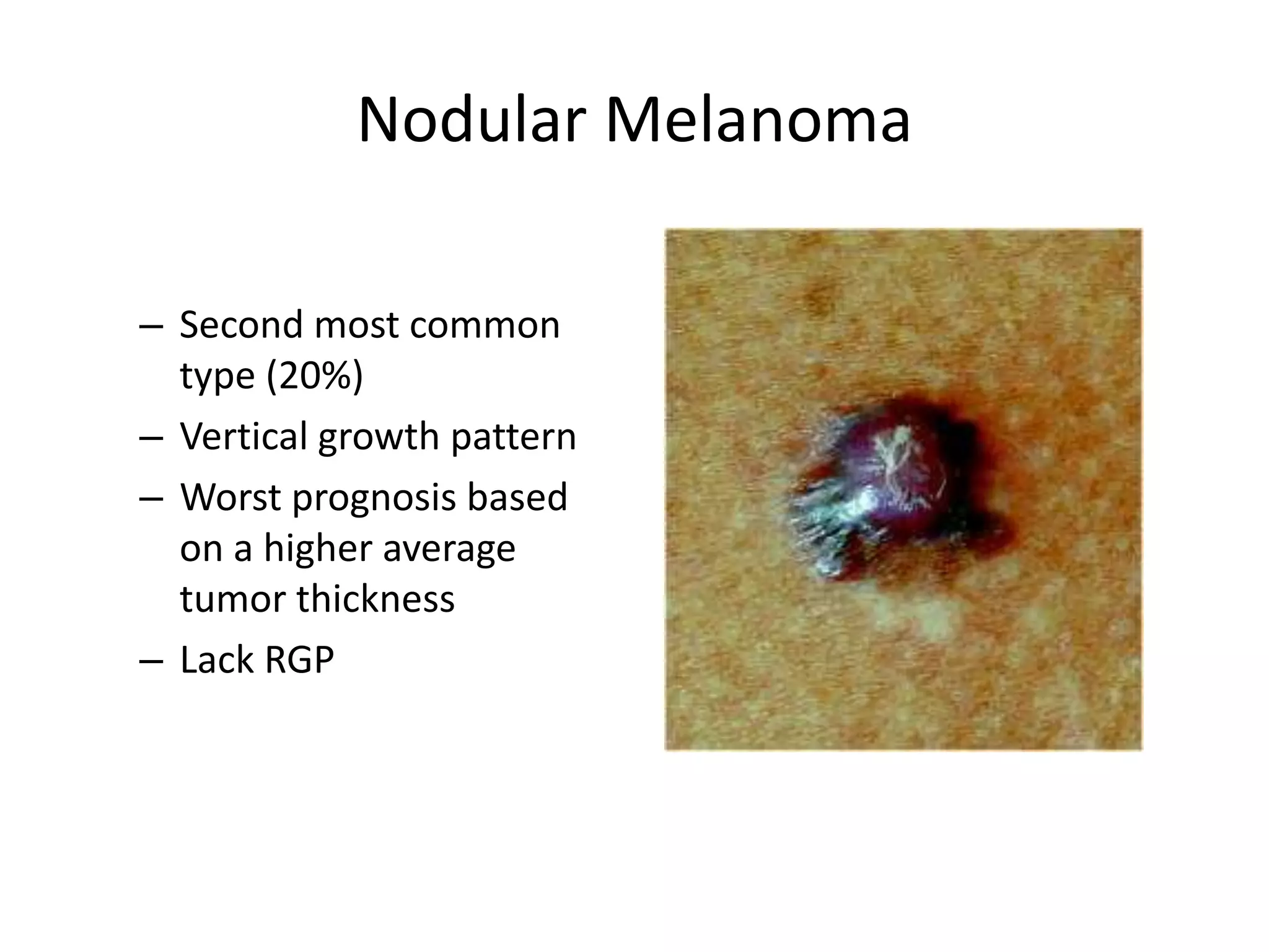 Melanoma clinical features, pathology and management | PPTX