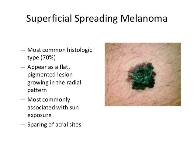 Superficial Spreading Melanoma Stages