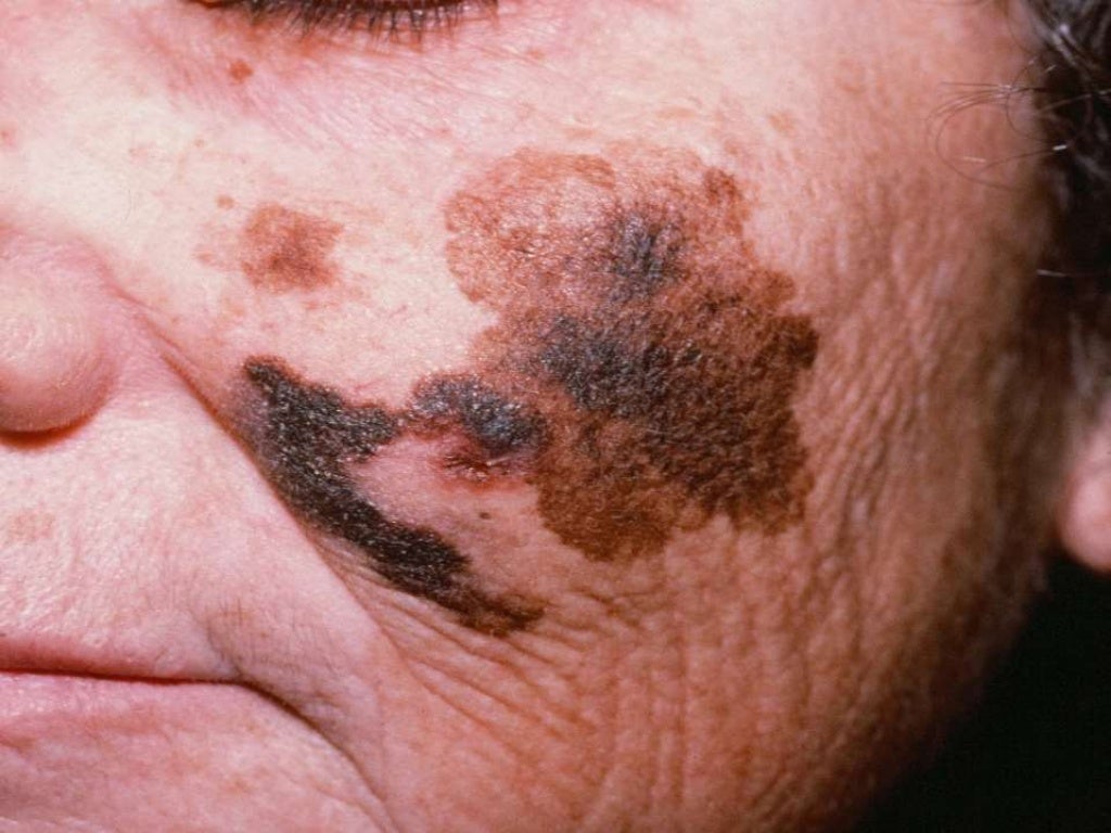 Cáncer De Piel Melanoma
