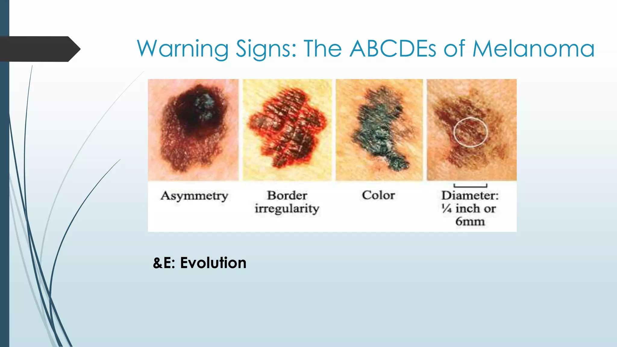 Melanoma | PDF | Skin and Dermatology | Diseases and Conditions
