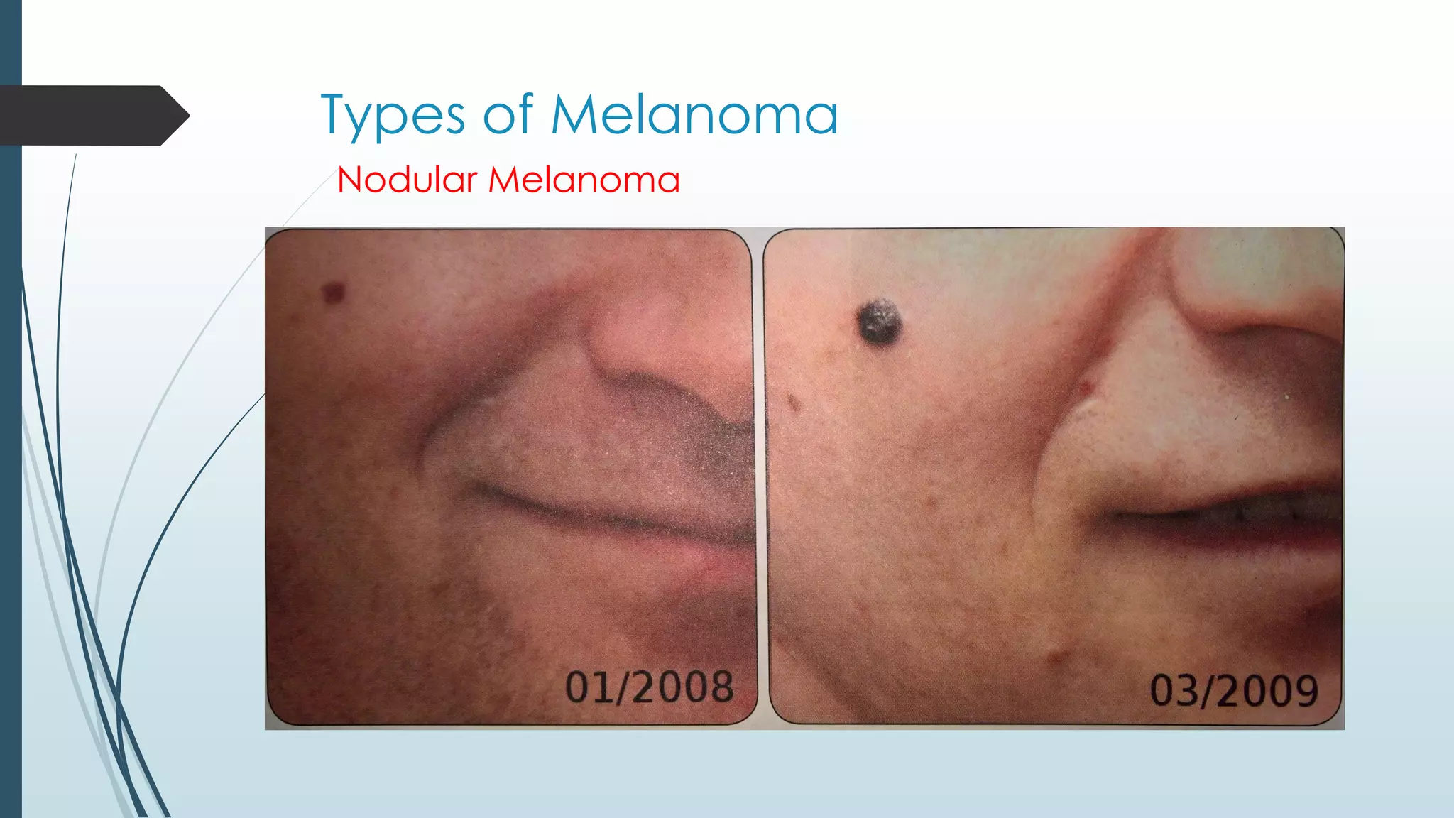 Melanoma | PDF | Skin and Dermatology | Diseases and Conditions