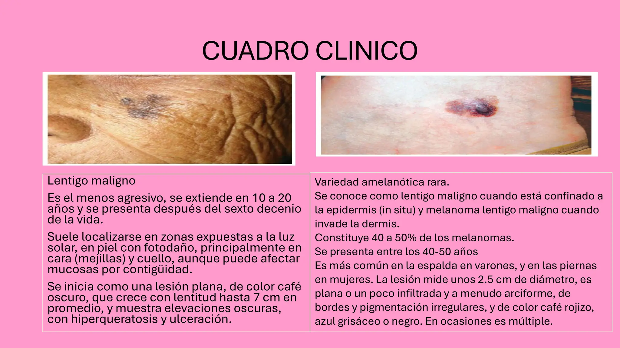 MELANOMA y CARCINOMA BASOCELULAR, EPIDERMOIDE, EPIDERMOIDE IN SITU ...