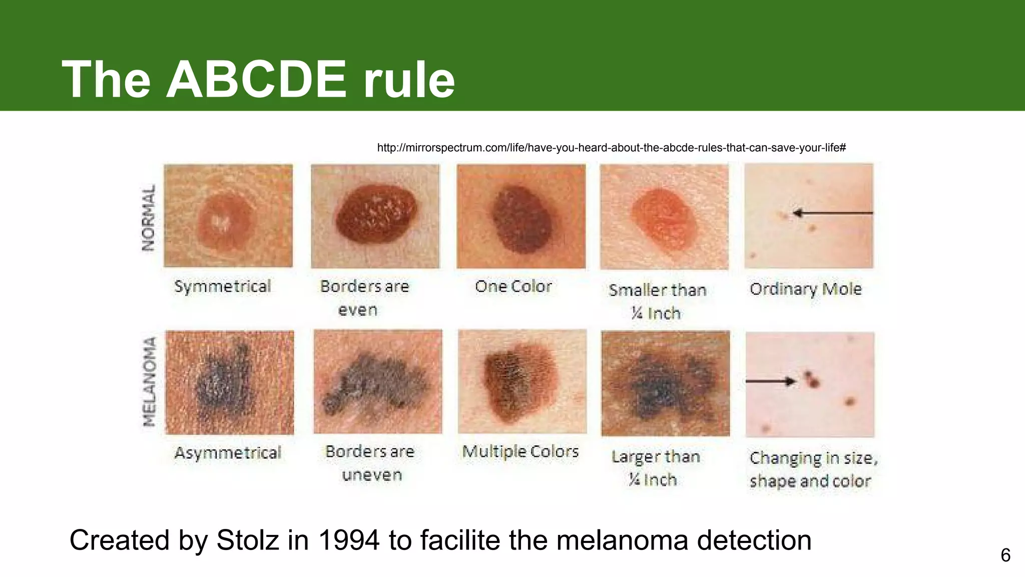 Melanoma: how to detect skin cancer | PDF