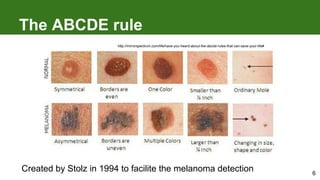 Melanoma: how to detect skin cancer | PDF | Cancer | Diseases and ...