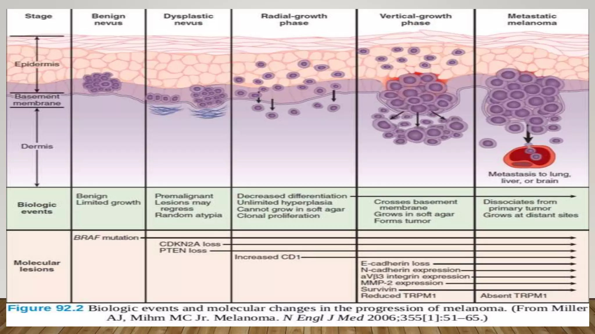 MALIGNANT MELANOMA--- STAGING AND WORKUP | PPT