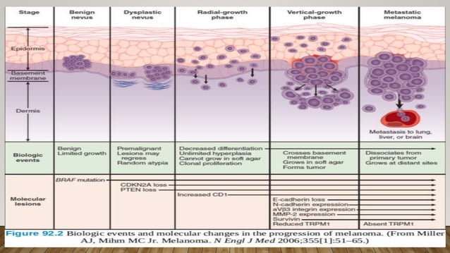 MALIGNANT MELANOMA--- STAGING AND WORKUP | PPT