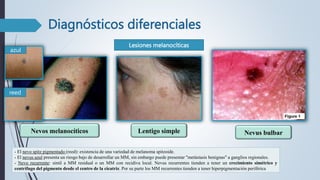 MELANOMA MALIGNO.pptx