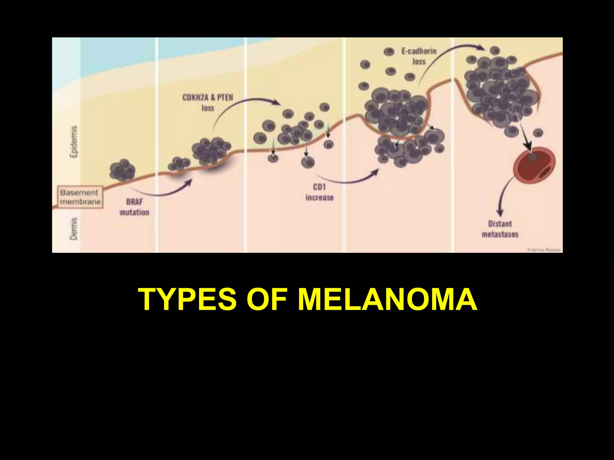 Melanoma and melanoma types with treatment | PPTX