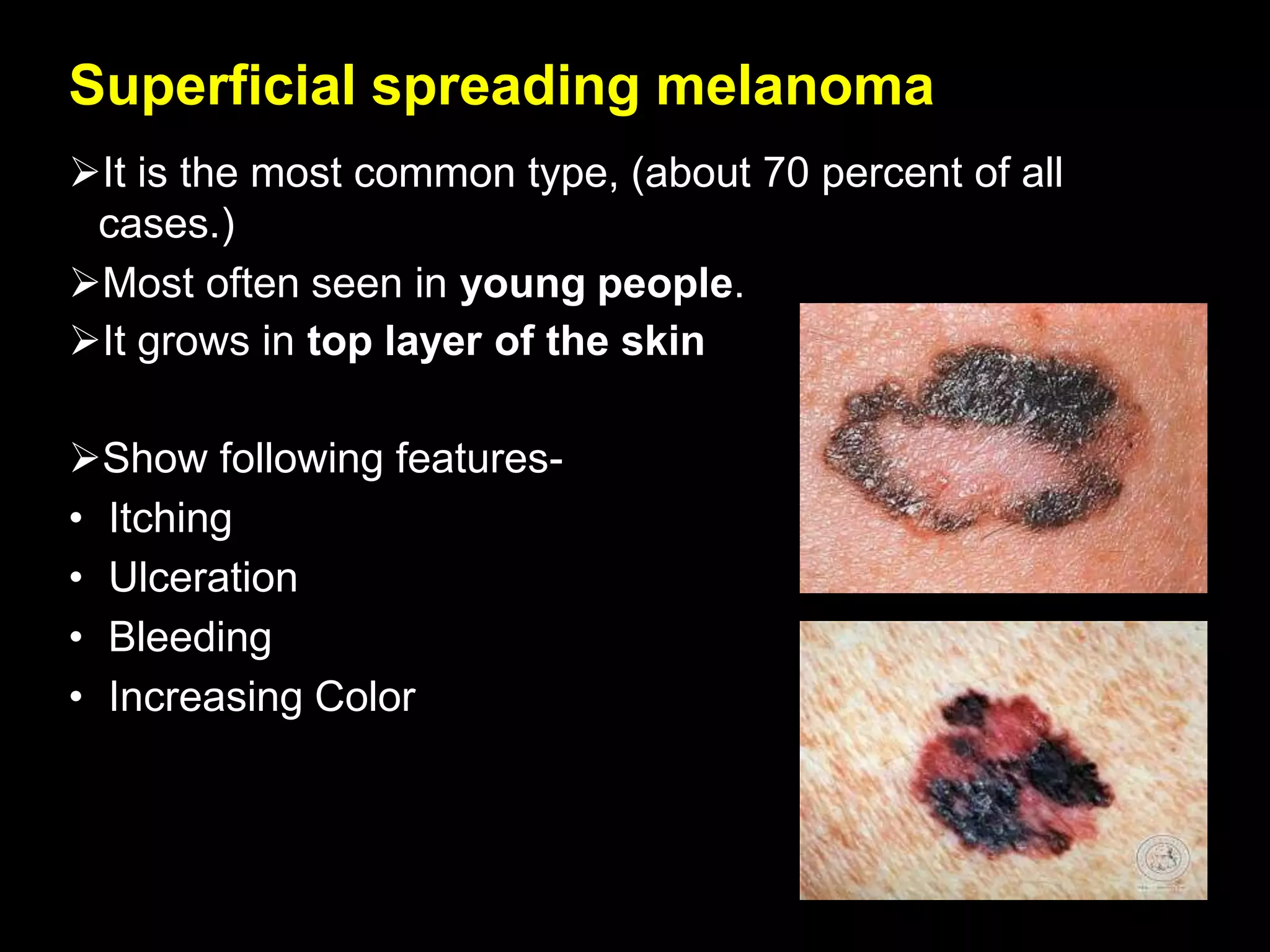 Melanoma and melanoma types with treatment | PPTX