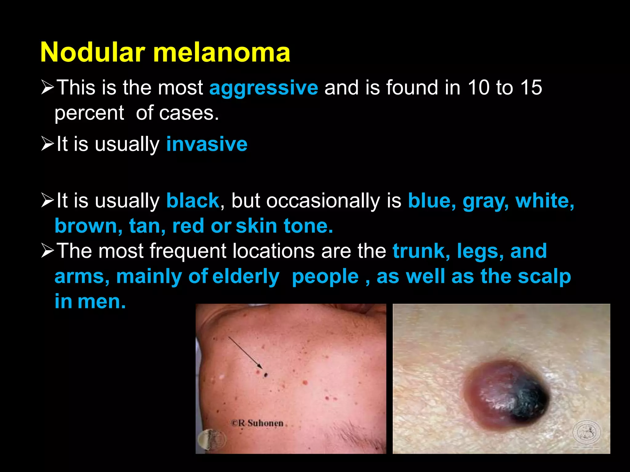 Melanoma and melanoma types with treatment | PPTX