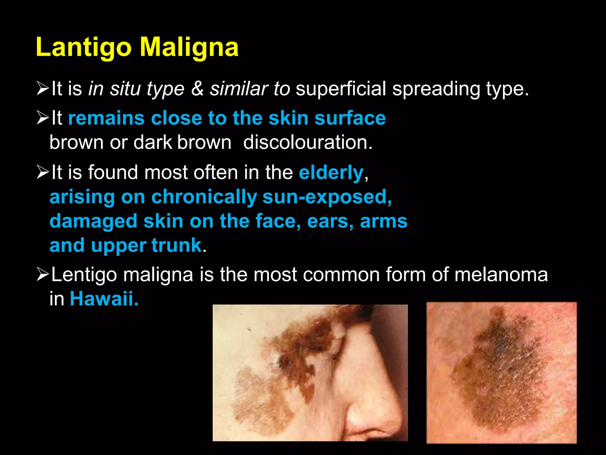 Melanoma and melanoma types with treatment | PPTX