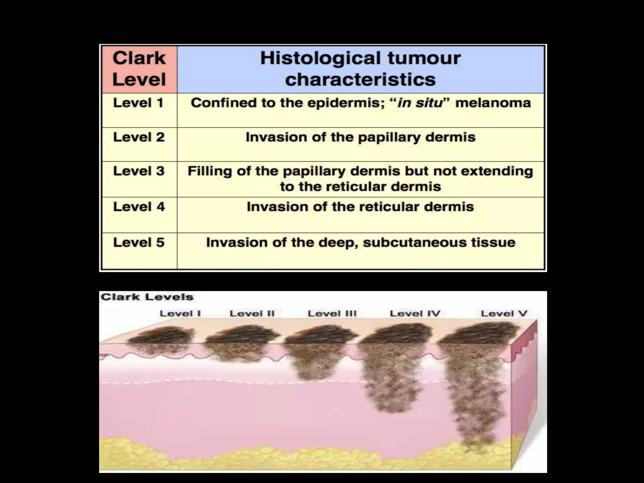 Melanoma and melanoma types with treatment | PPTX