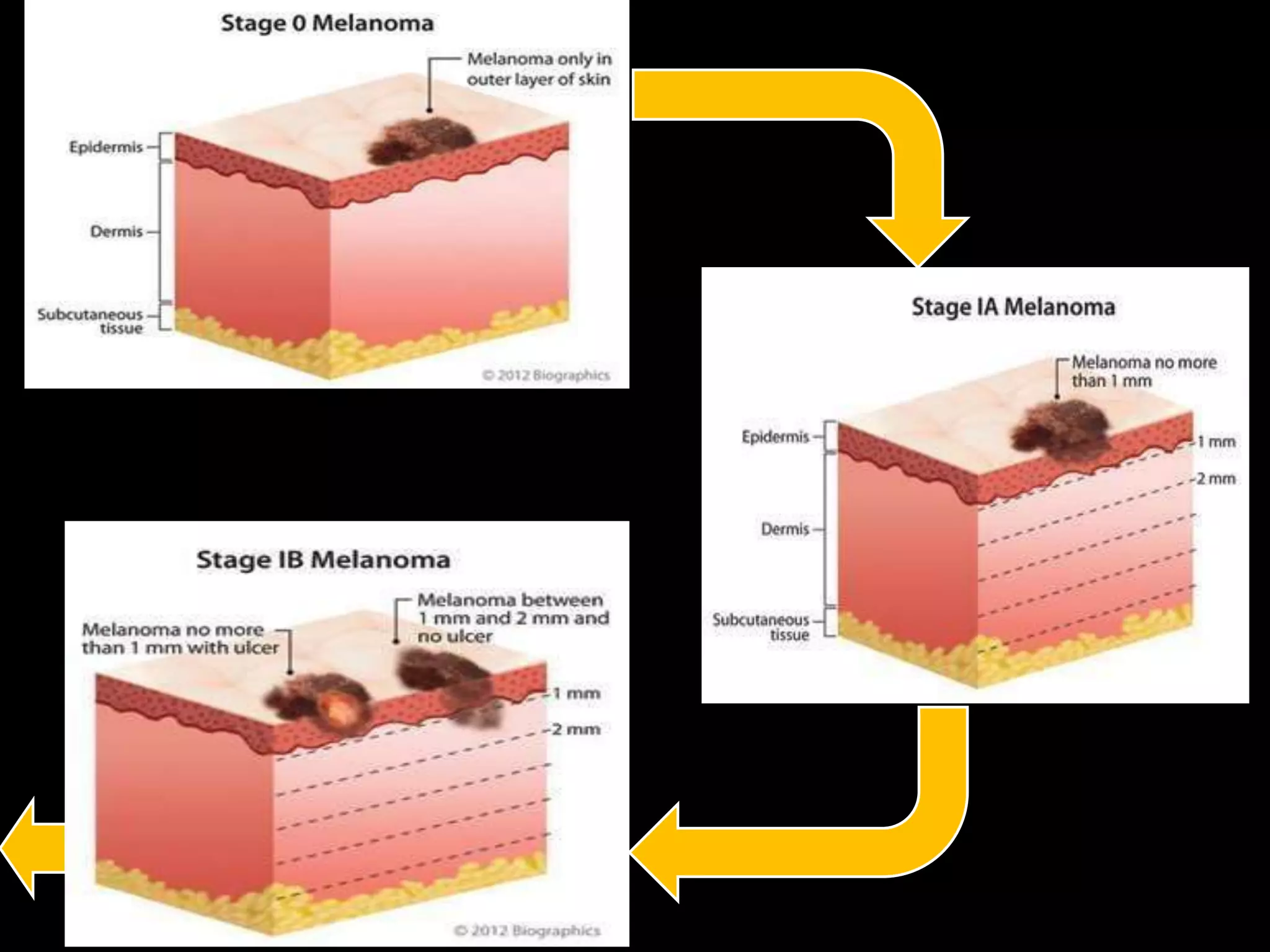 Melanoma and melanoma types with treatment | PPTX