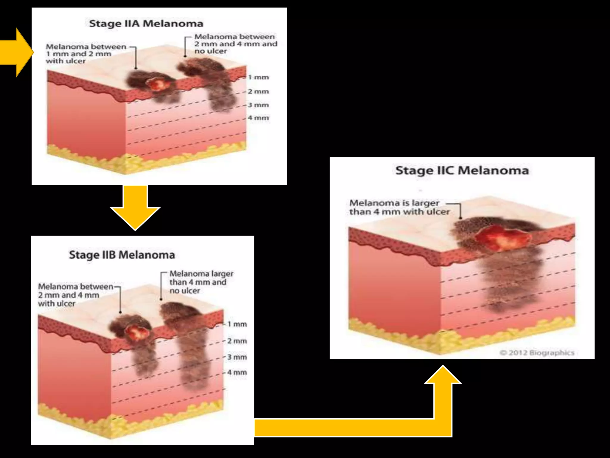 Melanoma and melanoma types with treatment | PPTX