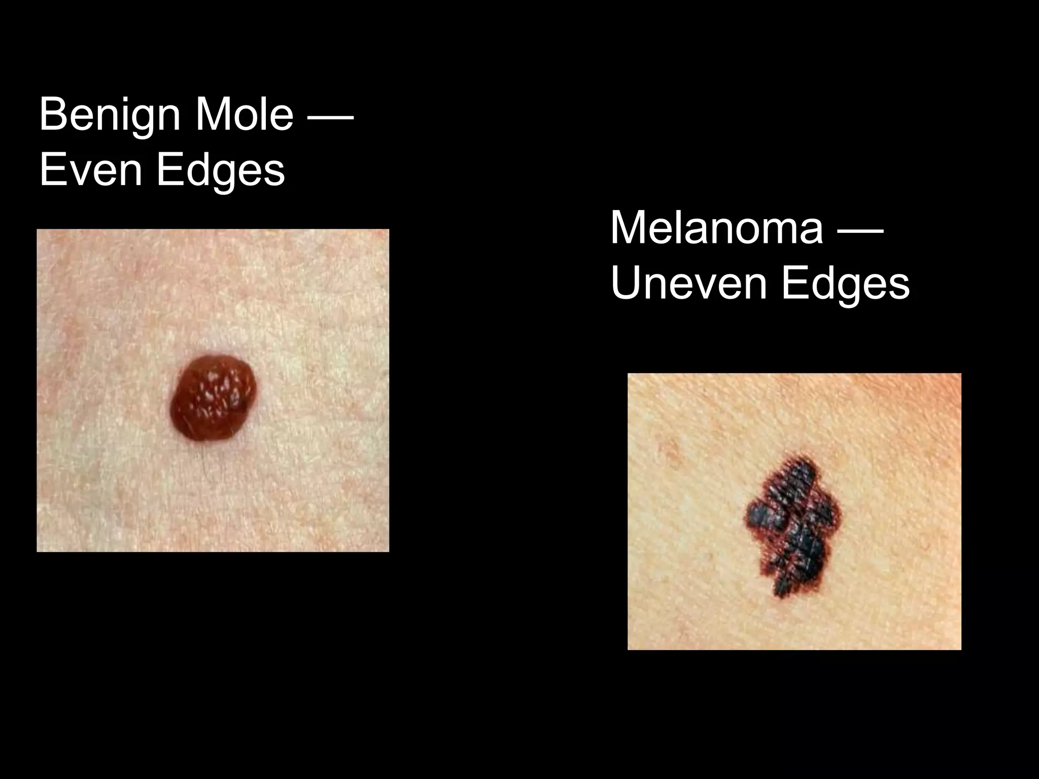 Melanoma and melanoma types with treatment | PPTX