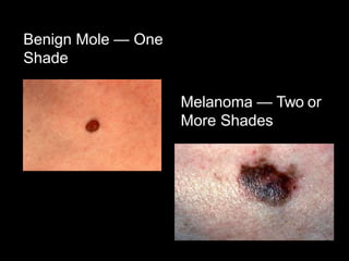 Melanoma and melanoma types with treatment | PPTX