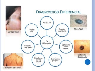 Melanomas | PPTX