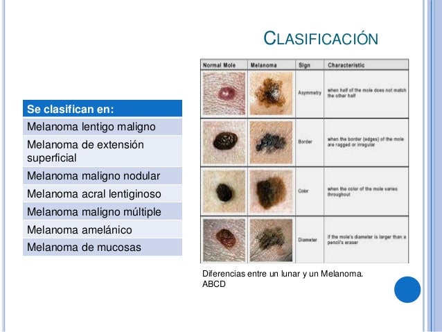 Melanomas