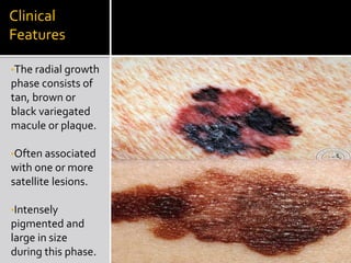 Melanomas by Syed M. Aun Raza | PPT