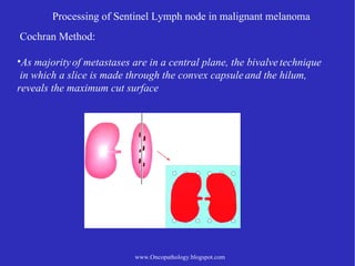 Melanoma Sentinel Lymph node | PPT