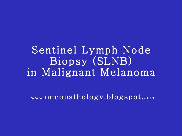 Sentinel lymph node biopsy - lilyfed Sentinel lymph node biopsy - lilyfed