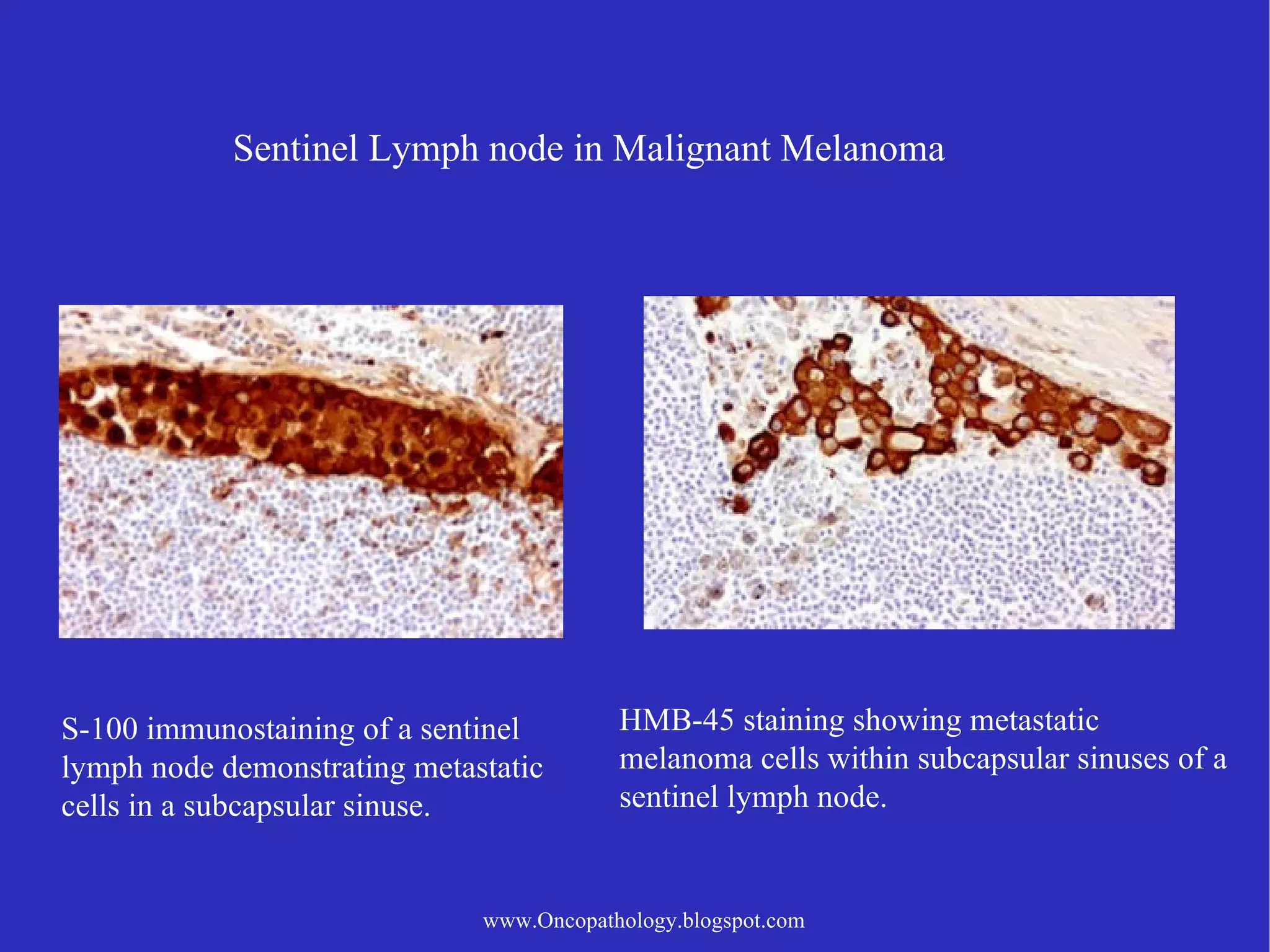 Melanoma Sentinel Lymph node | PPT