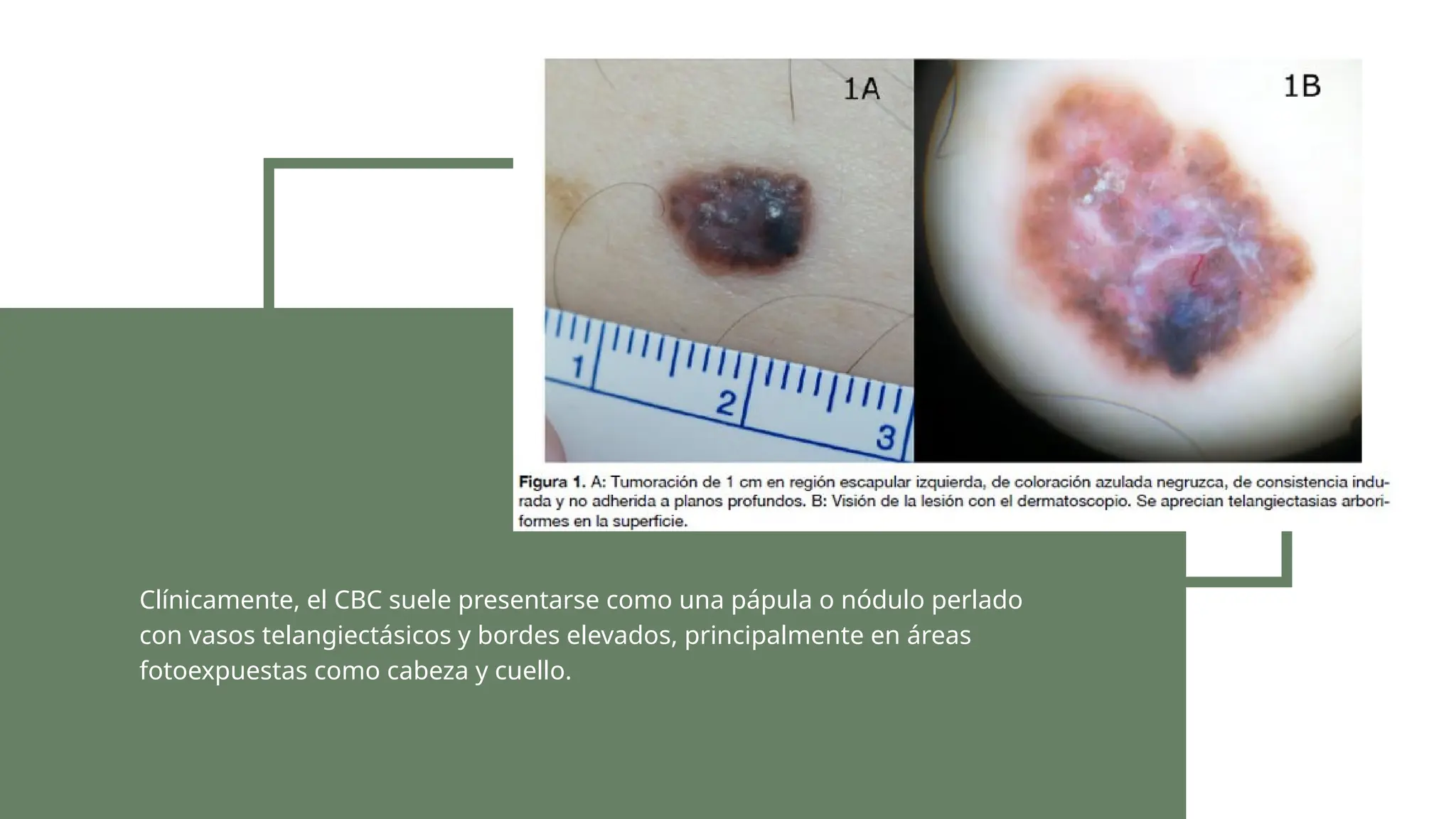 Melanoma y cancer basocelular presentacion | PPTX