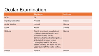 Melanom conjunctival Dr. Hapca Madalina.pptx