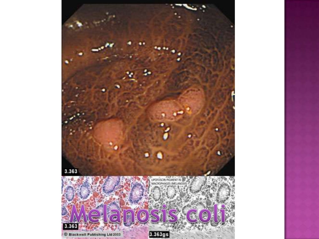 Melanosis coli y melanoma lhcc