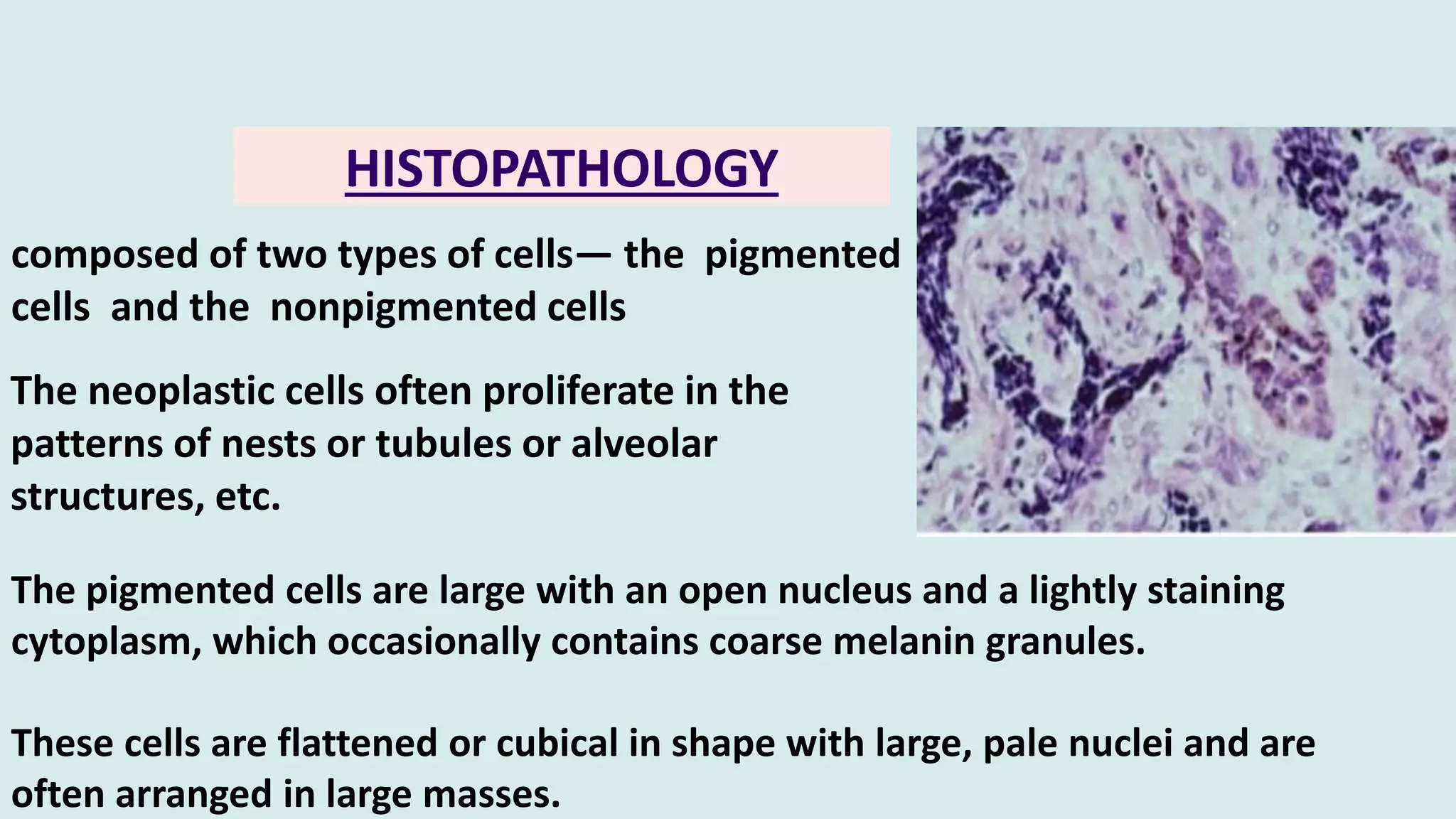 Melanotic Neuroectodermal Tumor Of Infancy Pptx