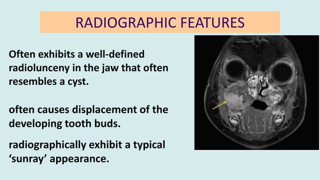 Melanotic Neuroectodermal Tumor Of Infancy Pptx Dental Health Diseases And Conditions