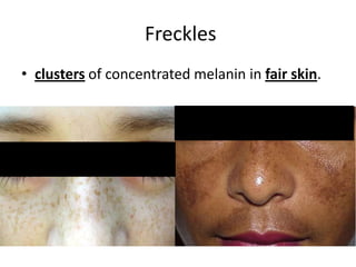 Comprehensive overview of melasma | PPTX