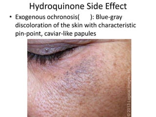 Comprehensive overview of melasma | PPT