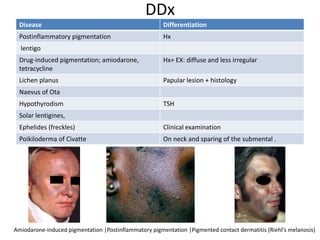 Comprehensive overview of melasma | PPT