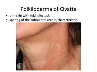 Comprehensive overview of melasma | PPT