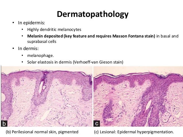 Comprehensive overview of melasma