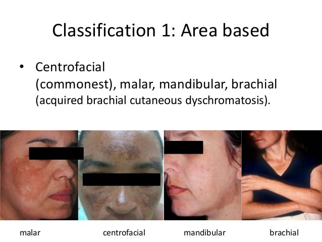 Comprehensive overview of melasma
