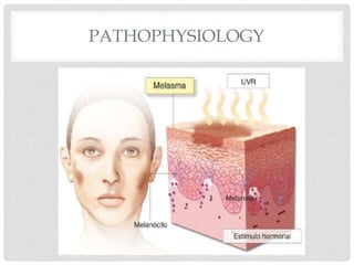 Melasma | PPTX