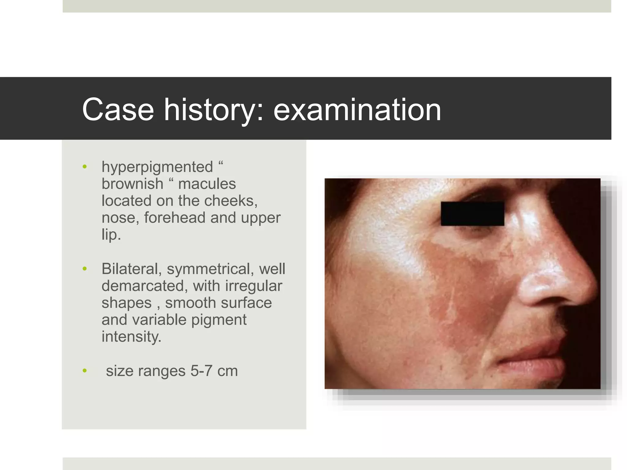 Melasma | PPTX