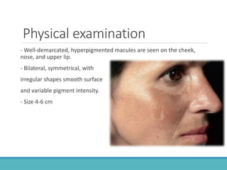 Melasma | PPT