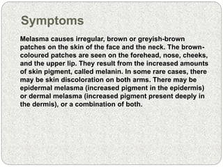 Melasma | PPTX