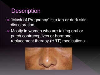 Melasma | PPT