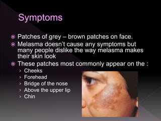 Melasma | PPT