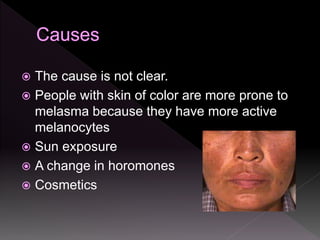 Melasma | PPTX
