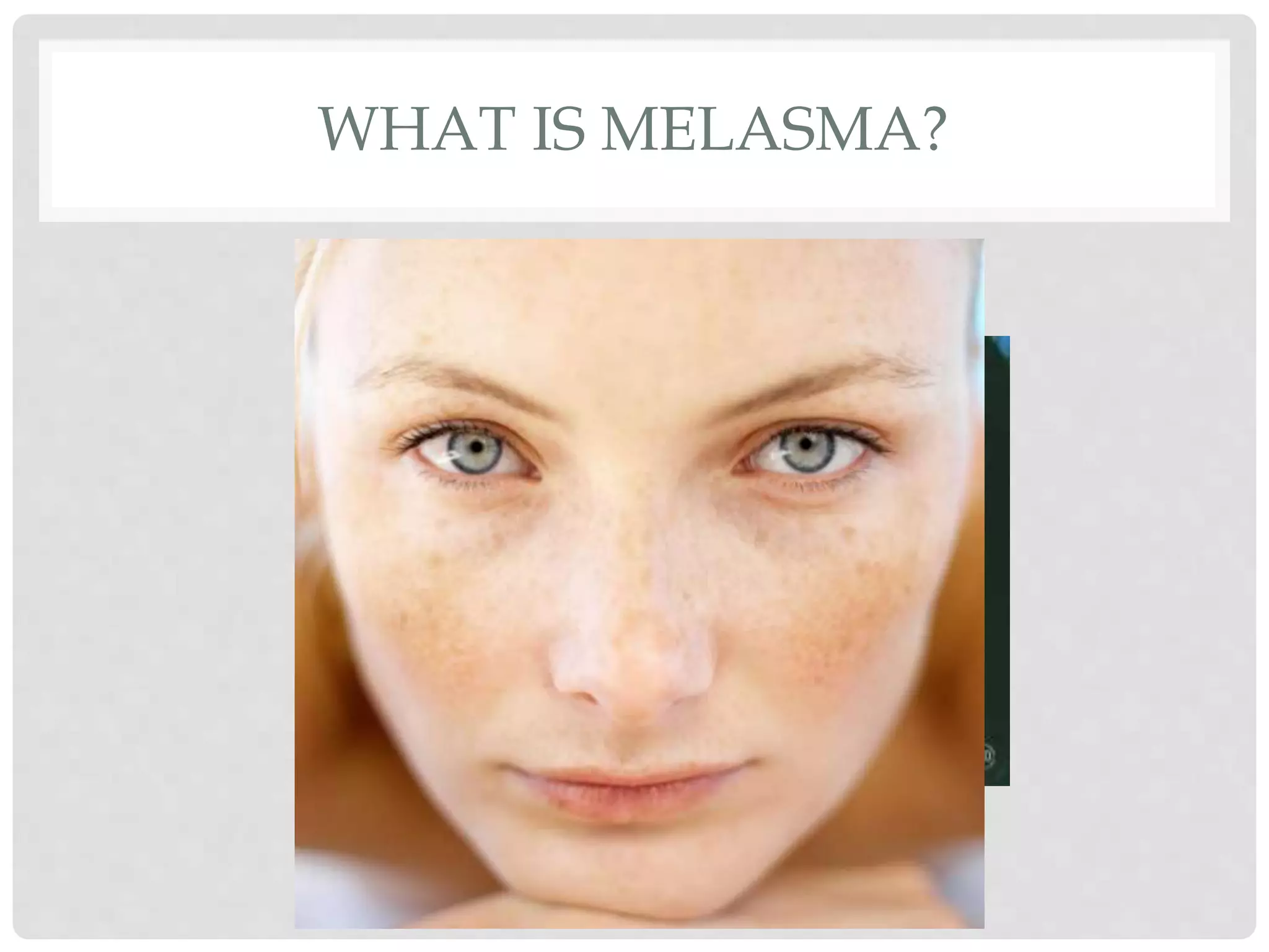 Melasma 14.03.2016 ben | PPTX