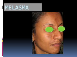 Melasma – epidemiology, classification - Prof. Torello Lotti, MD | PPTX ...