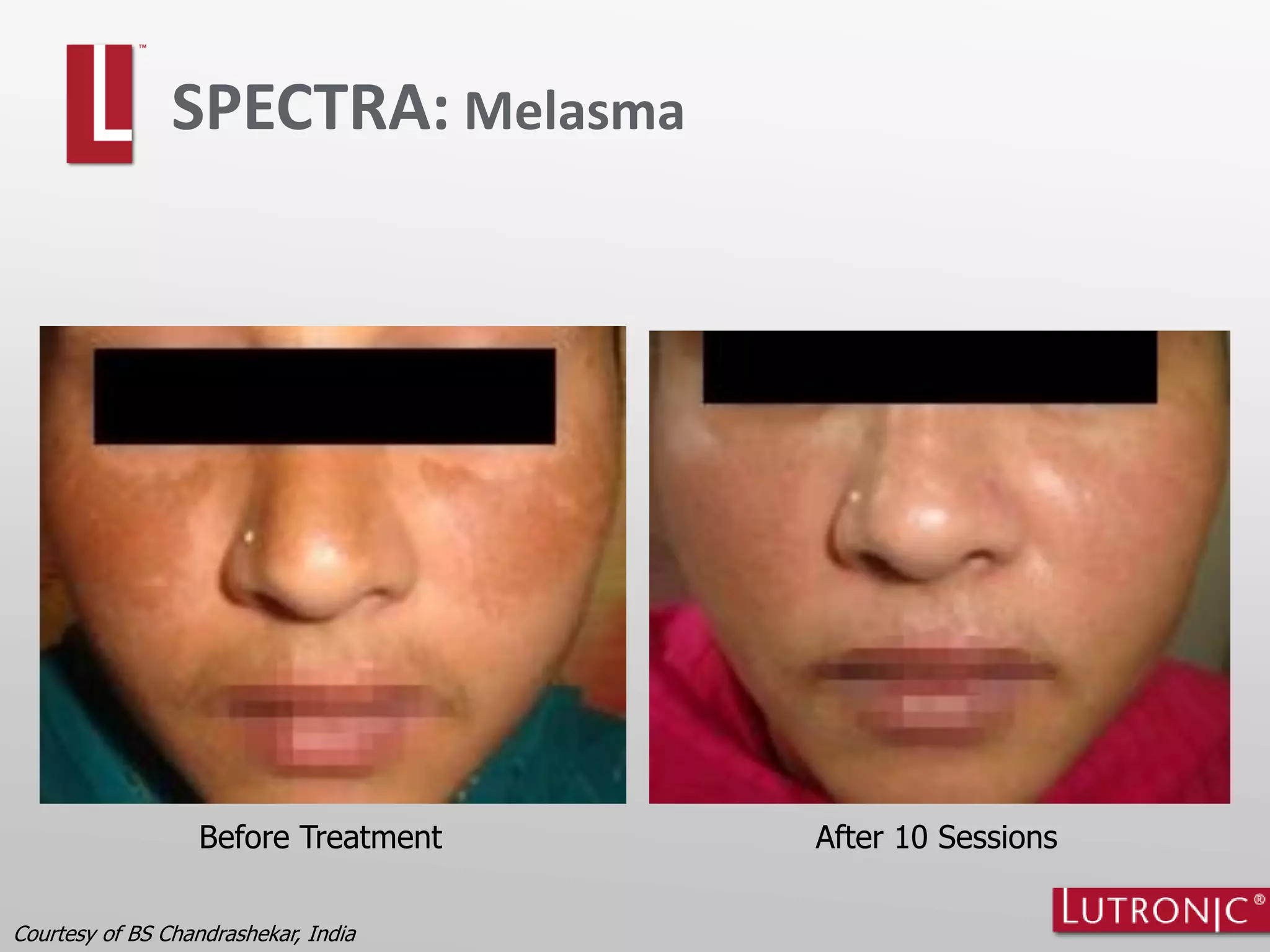 Melasma Results | PDF