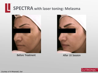Melasma Results | PDF