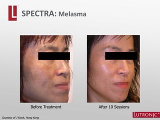 Melasma Results | PDF