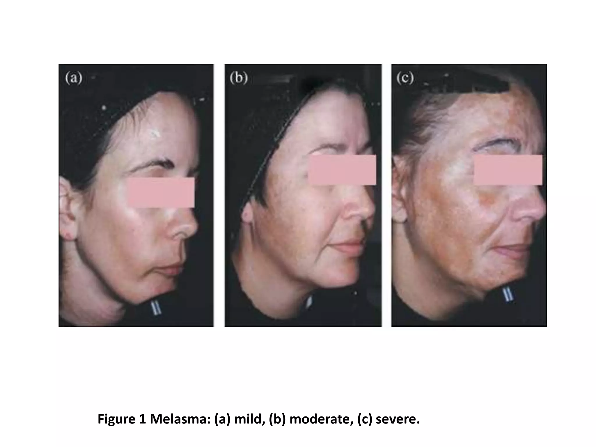 Melasma treatment | PPTX